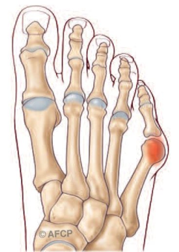 Quintus Varus - PiedVar